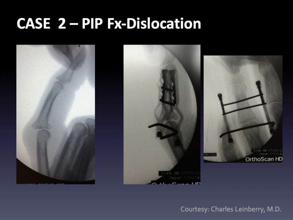 PIP Fracture Dislocation Archives - Virak Orthopedics