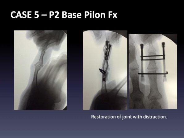 P2 Base Pilon Fractures Archives - Virak Orthopedics