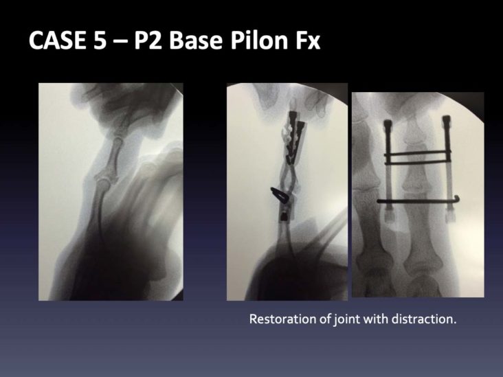 P2 Base Pilon Fractures Archives - Virak Orthopedics