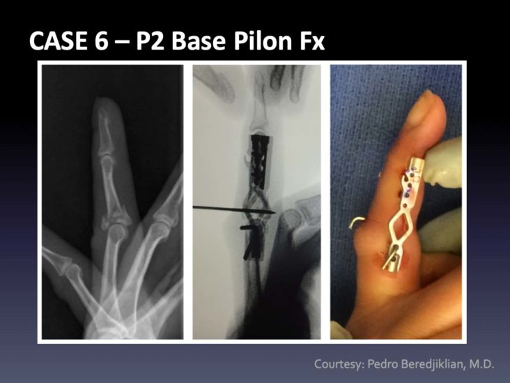 P2 Base Pilon Fractures Archives - Virak Orthopedics