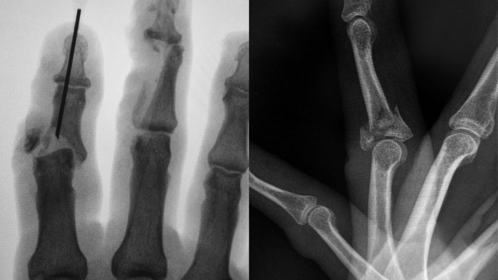 DigiFix System Clinical Overview - Virak Orthopedics