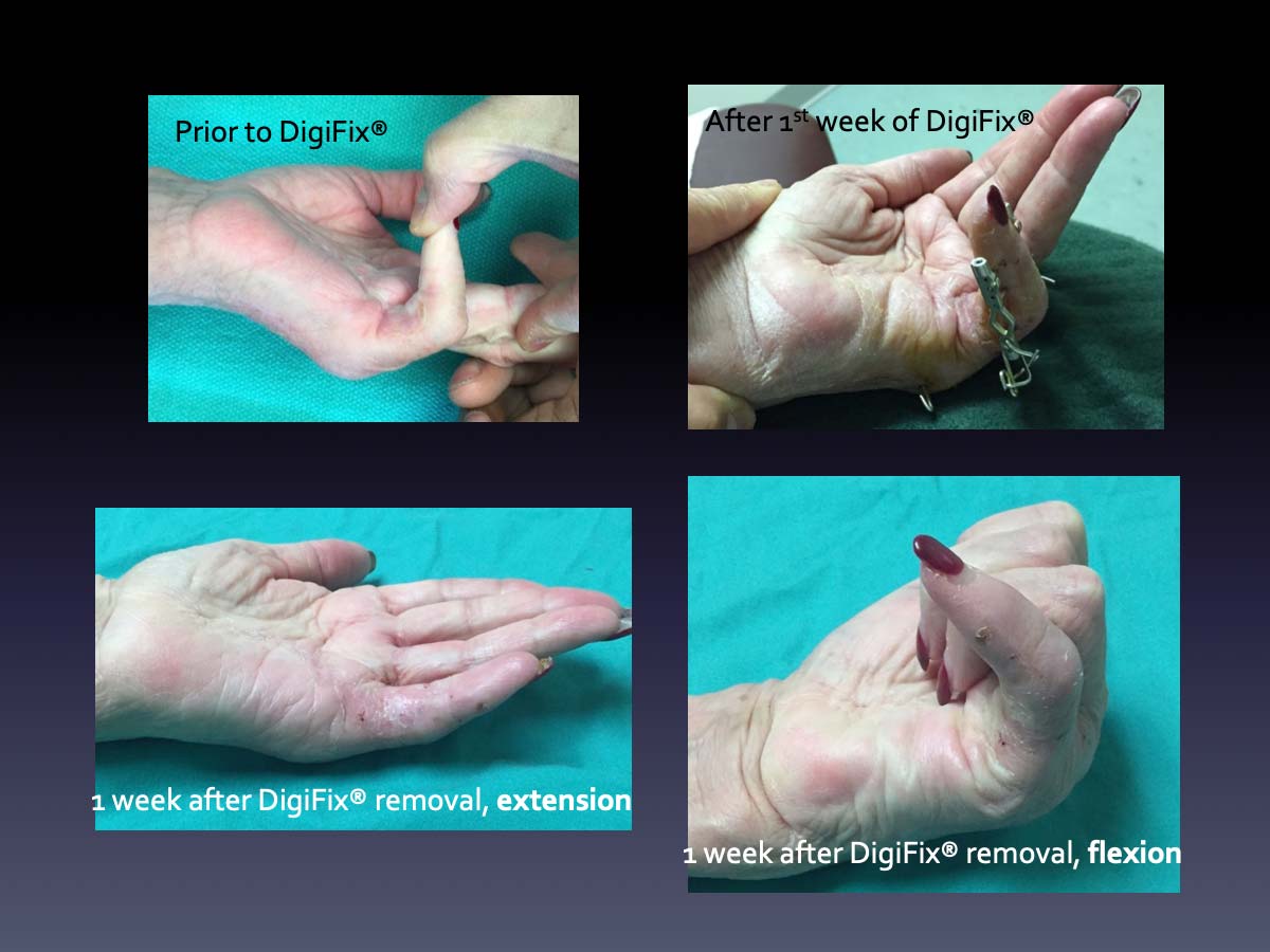The FDA approves the DigiFix® External Fixator for Dupuytren’s ...