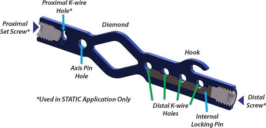 DigiFix: A Unique Versatile Small Bone Mini Ex-Fix by Virak Orthopedics