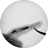 DigiFix: A Unique Versatile Small Bone Mini Ex-Fix by Virak Orthopedics