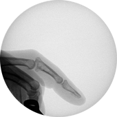 DigiFix: A Unique Versatile Small Bone Mini Ex-Fix by Virak Orthopedics